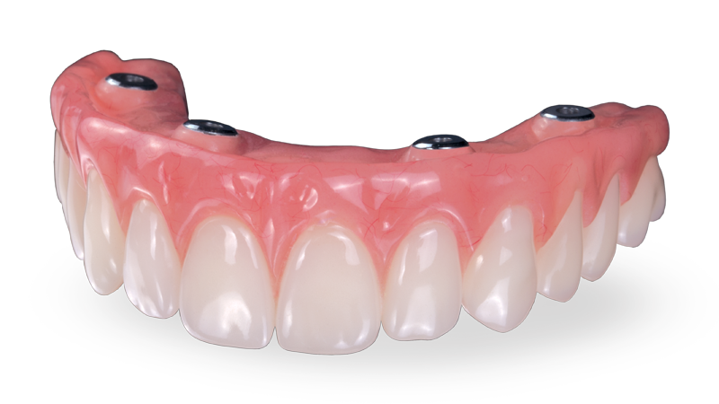 Hybrid Denture || Smile Stones Dental Pvt Ltd