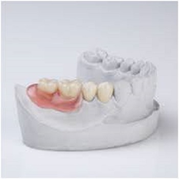 Precision Attachment || Smile Stones Dental Pvt Ltd